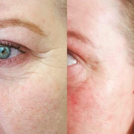 Microneedling Mississauga – Aqua Clinic